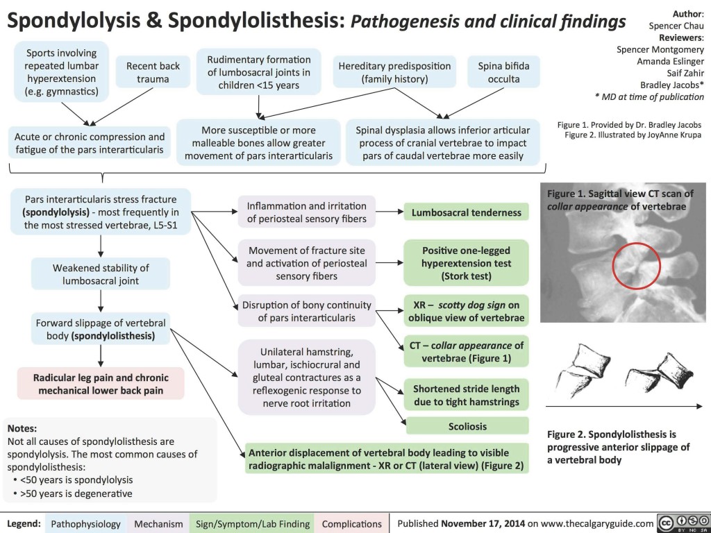 Spondylolysis & Spondylolisthesis: Pathogenesis and Clinical Findings ...