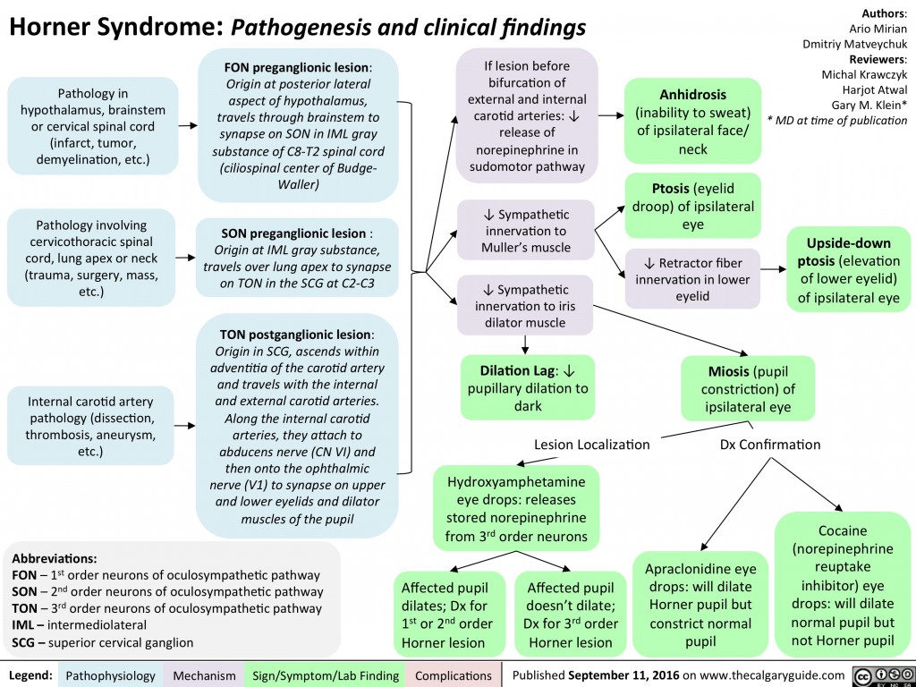 Horner Syndrome: Pathogenesis and Clinical Findings | Calgary ...