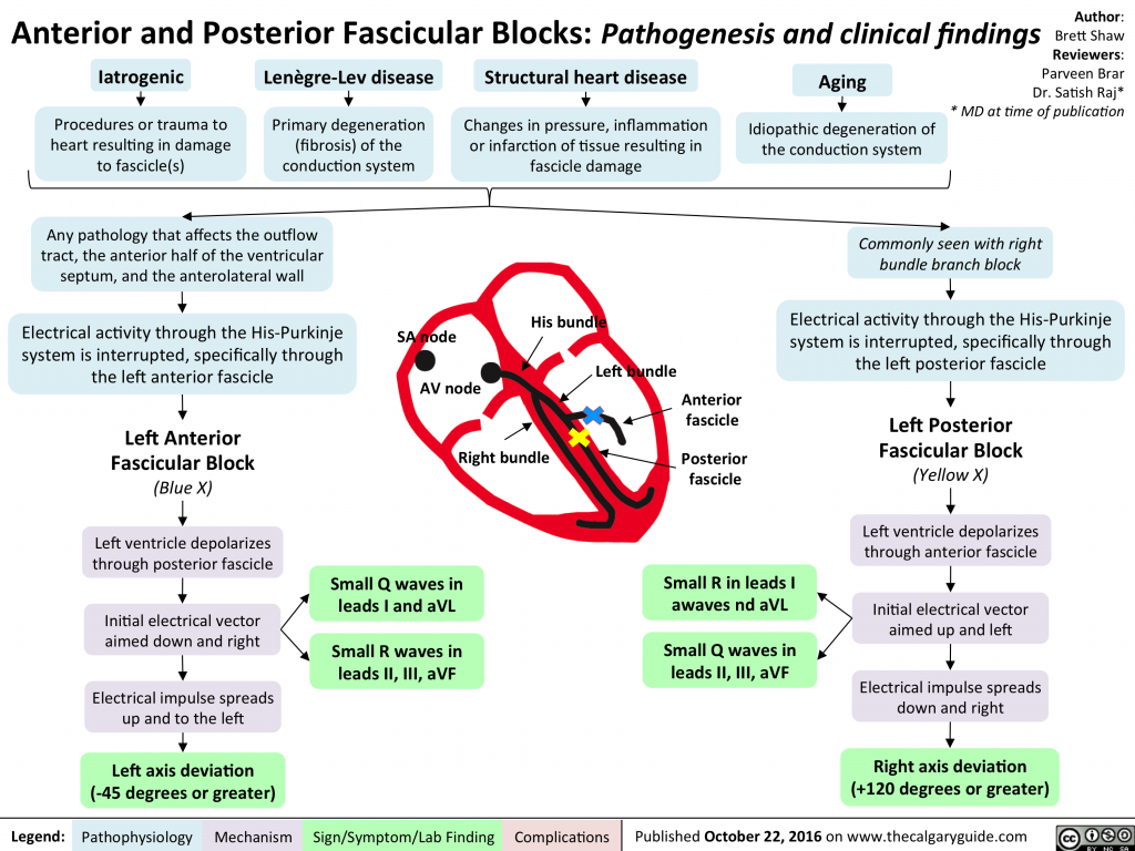 Anterior and Posterior Fascicular Blocks: Pathogenesis and clinical ...