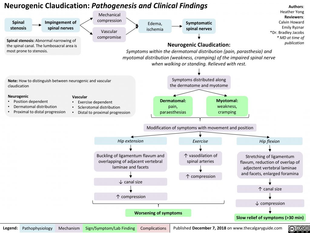 Neurogenic Claudication: Pathogenesis and Clinical Findings | Calgary Guide