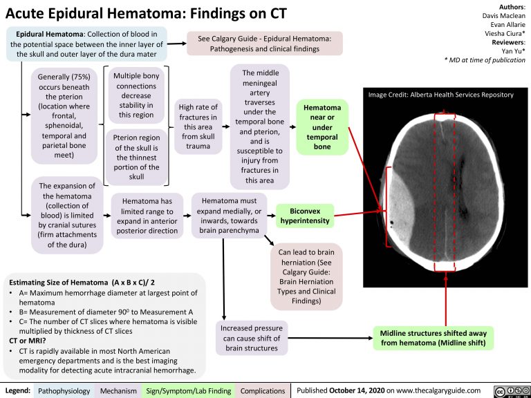 Epidural Hematoma: Findings on CT | Calgary Guide Epidural Hematoma: Findings on CT | Calgary Guide