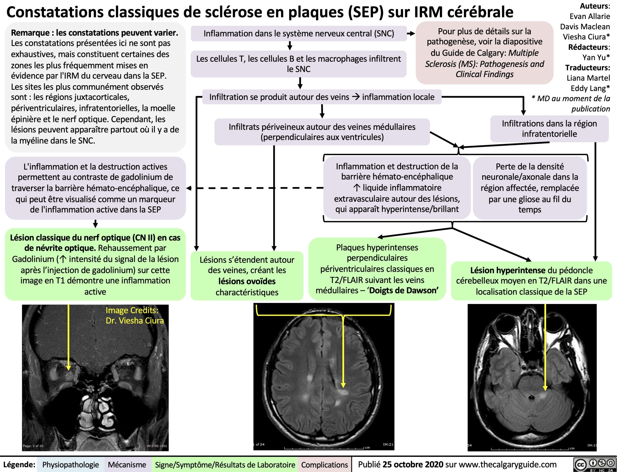 constatations-classiques-de-sclerose-en-plaques-sep-sur-irm-cerebrale ...