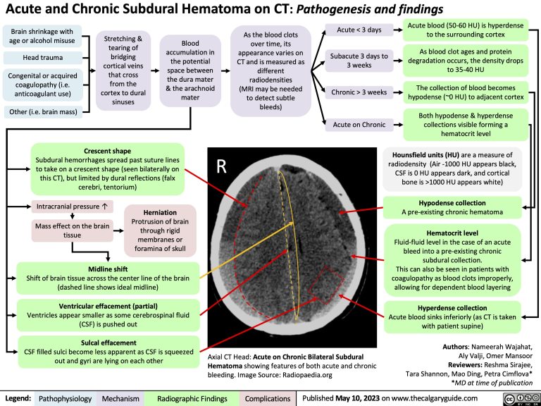 Subdural Hematoma on CT: Pathogenesis and findings | Calgary Guide Subdural Hematoma on CT: Pathogenesis and findings | Calgary Guide