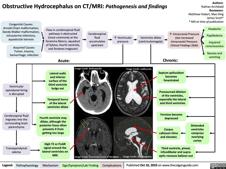 Obstructive Hydrocephalus on CT MRI Pathogenesis and findings | Calgary ...