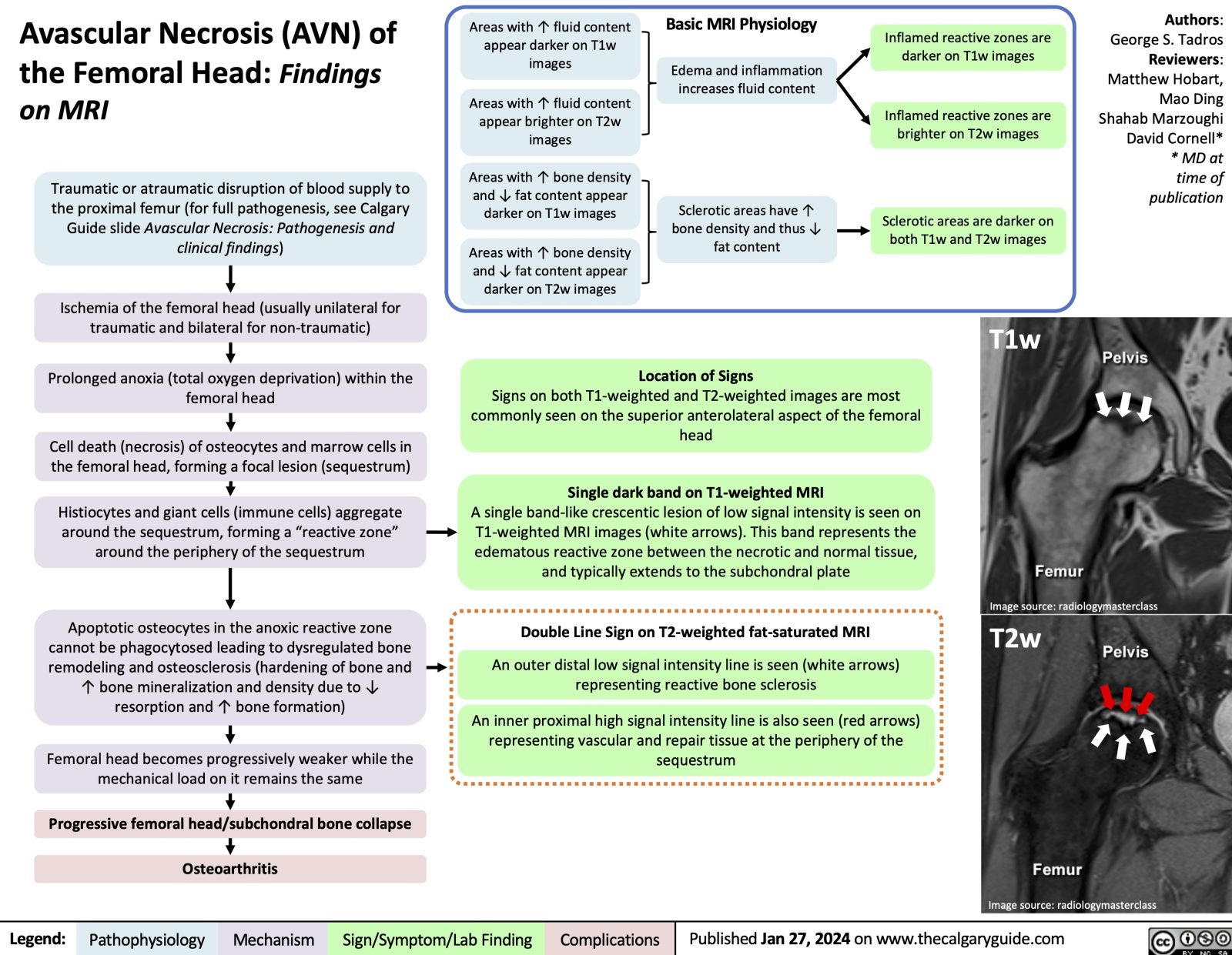 Avascular Necrosis (AVN) of the Femoral Head: Findings on MRI | Calgary ...