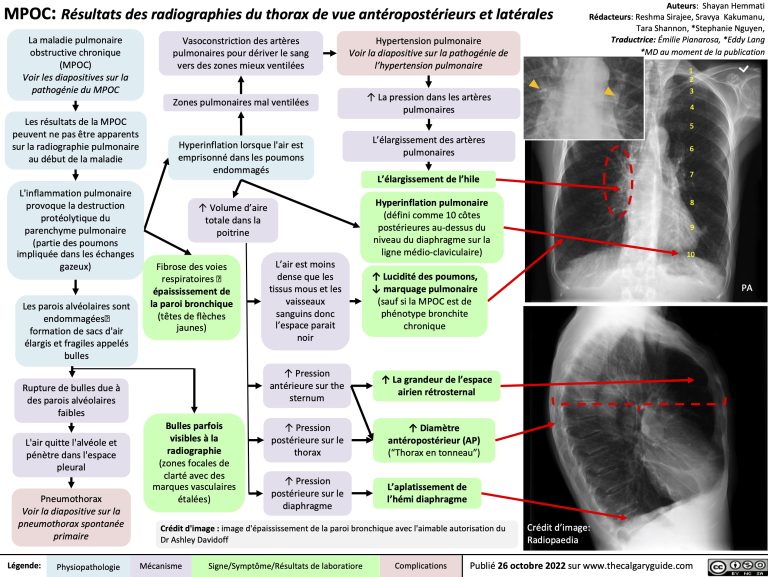 MPOC: Résultats des radiographies du thorax | Calgary GuideCalgary Guide
